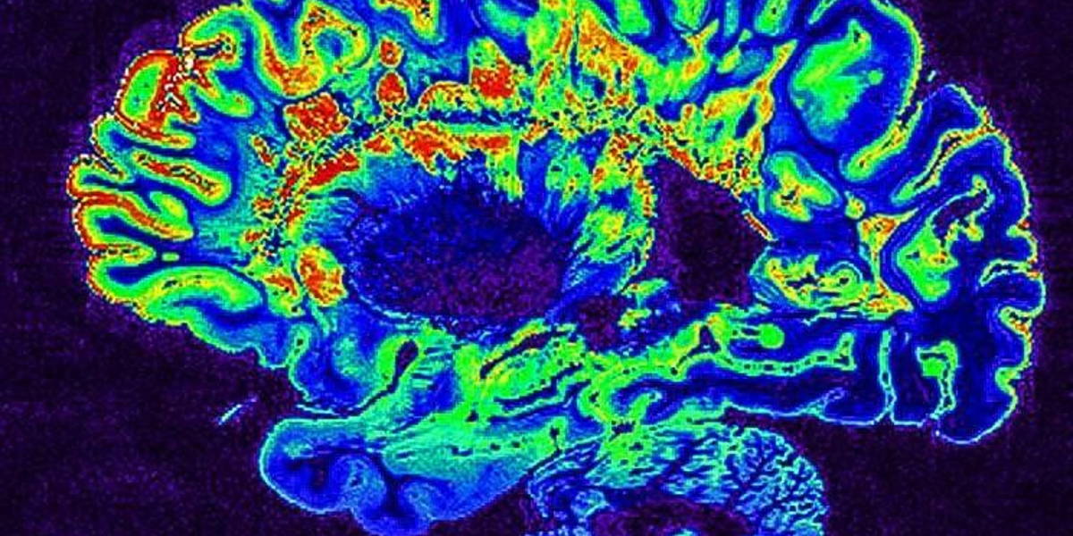 Nieuw AI-model genereert 3D MRI-beelden van hersenen | ICT&health