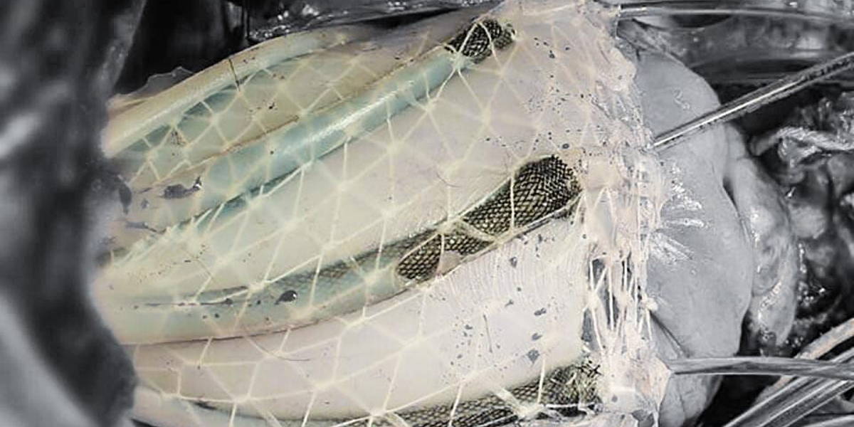 New soft robotic sleeve helps heart beat | ICT&health