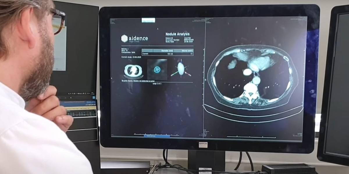 AI-software spoort naar afwijkingen op longfoto's | ICT&health