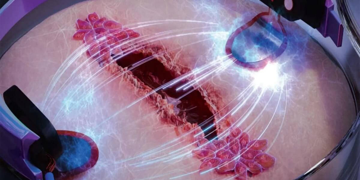 Healing Wounds Faster with Electrical Stimulation | ICT&health Global