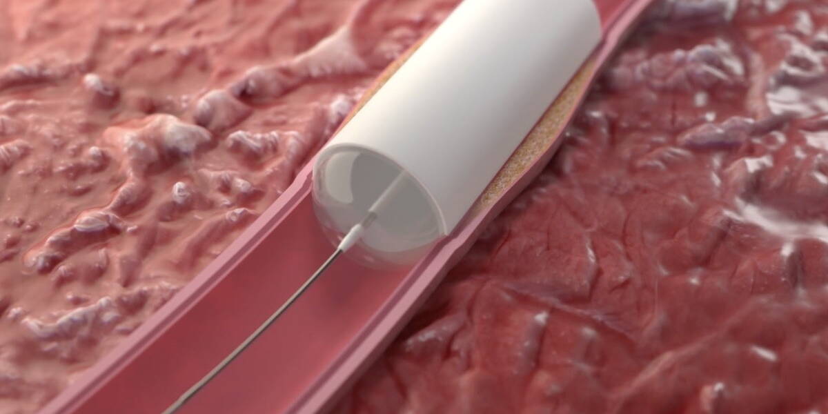 STENTiT plaatst voor het eerst afbreekbare stent bij patiënt | ICT&health