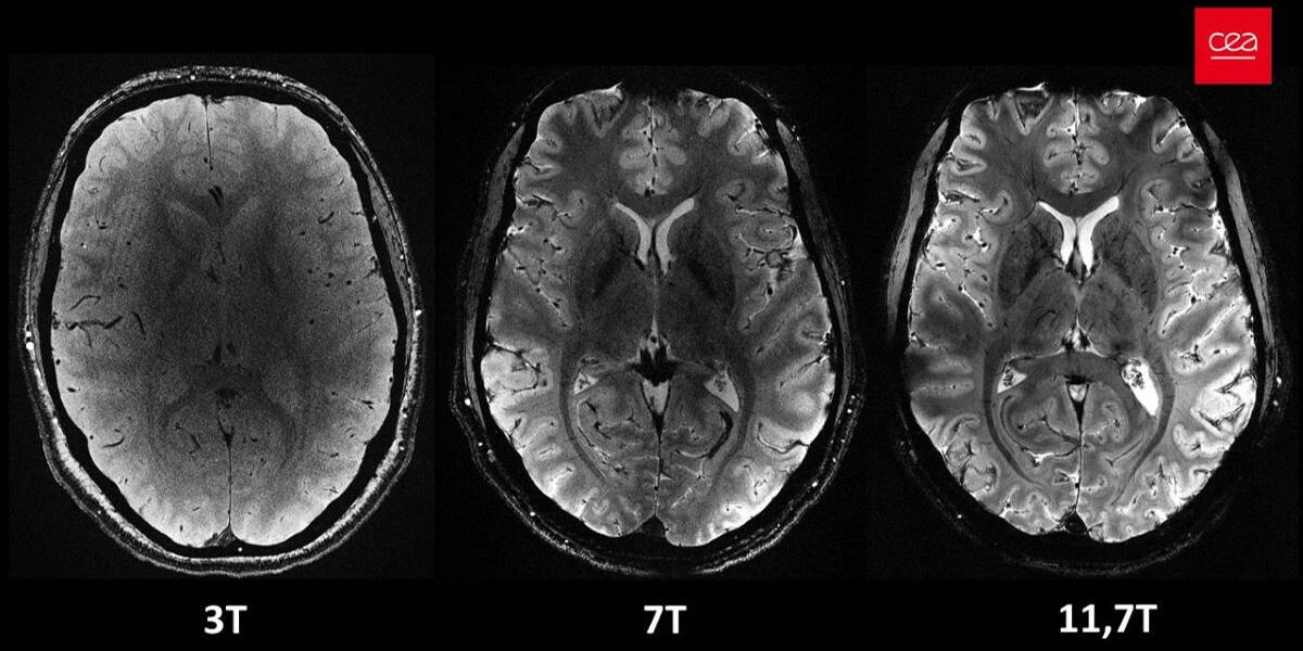 Grootst MRI-Scanner ooit toont hersenen in hogere resolutie | ICT&health