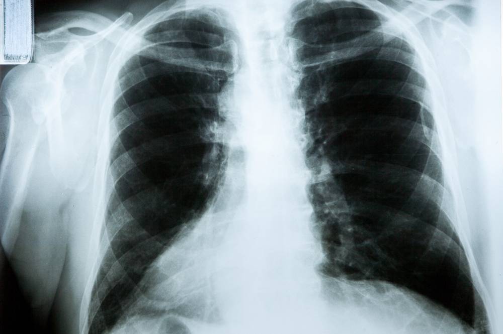 AI-systeem JBZ beoordeelt longfoto's op COVID-19 - ICT&health | Het ...