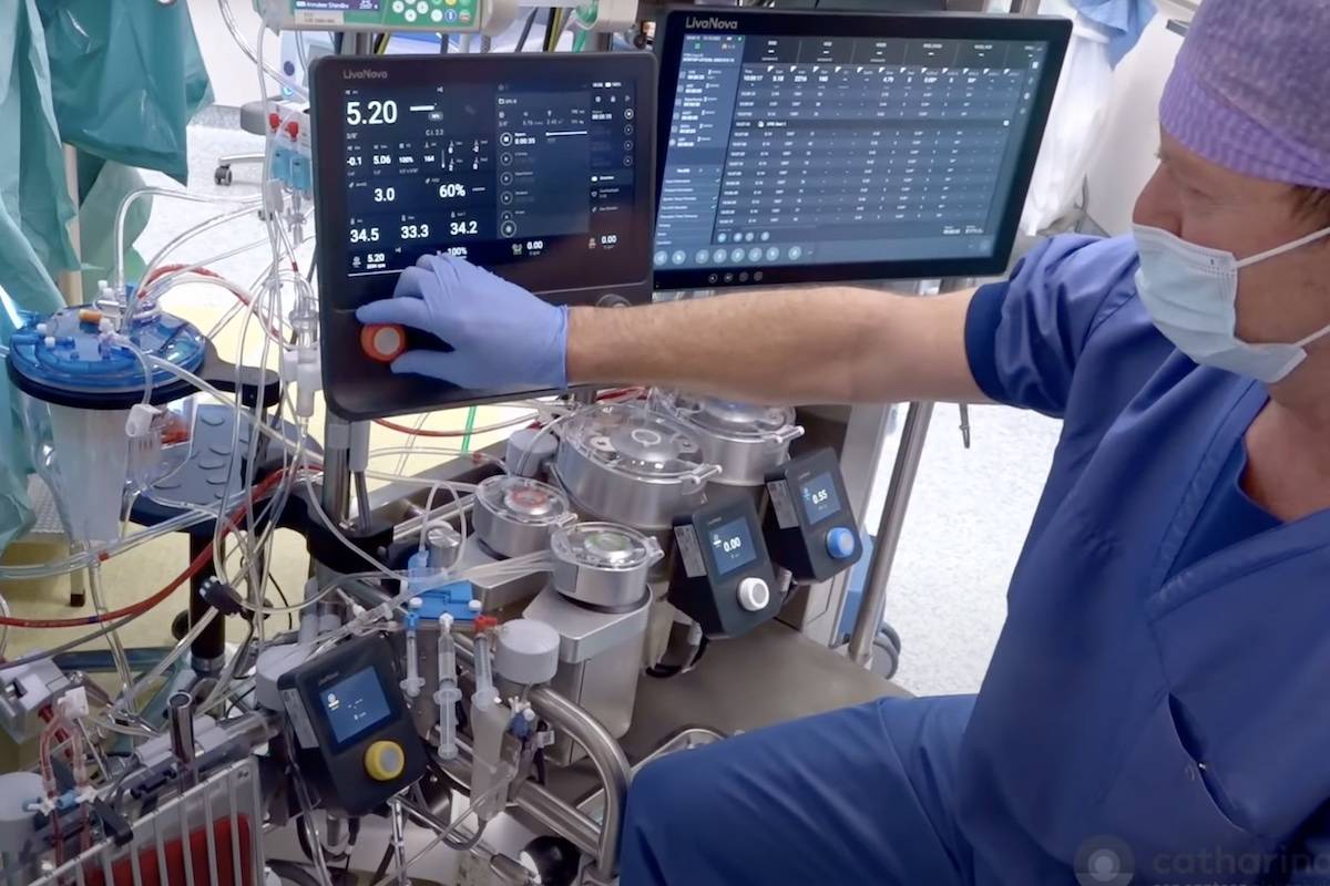 Nieuwe hart-longmachine kan realtime bloed meten - ICT&health | Het ...