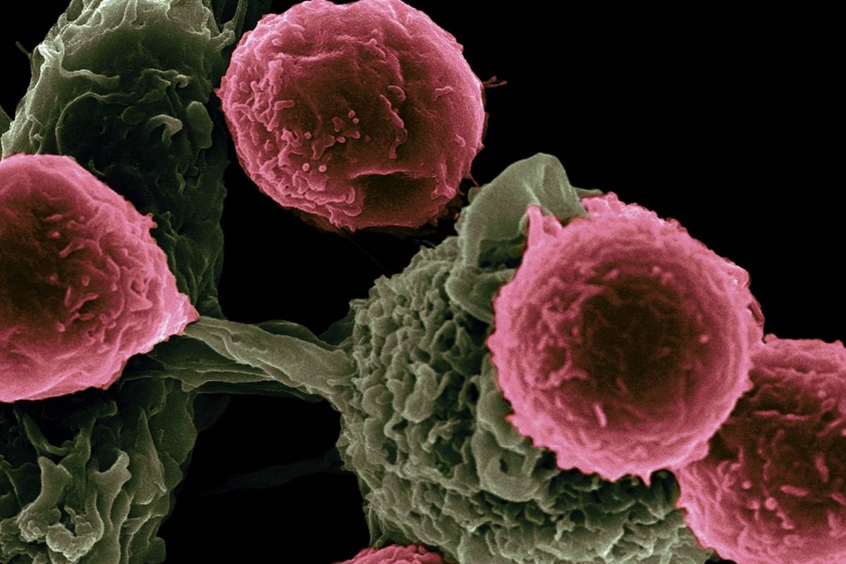 T-cellen herkennen tumor met nieuwe techniek - ICT&health | Het ...